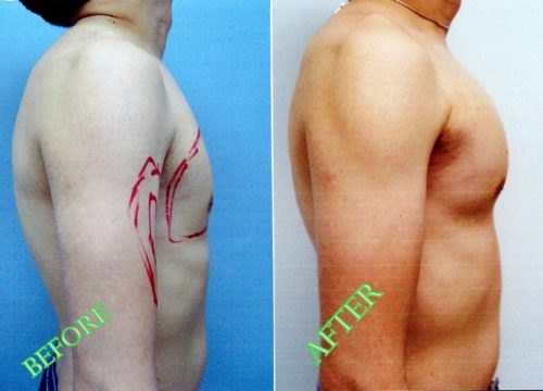 before-after-pectoral-implants-02 | Gravity Medical Spa