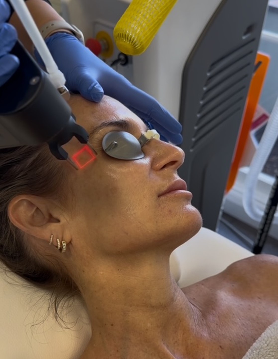 CoolPeel™ in South Orange County | Gravity Medical Spa
