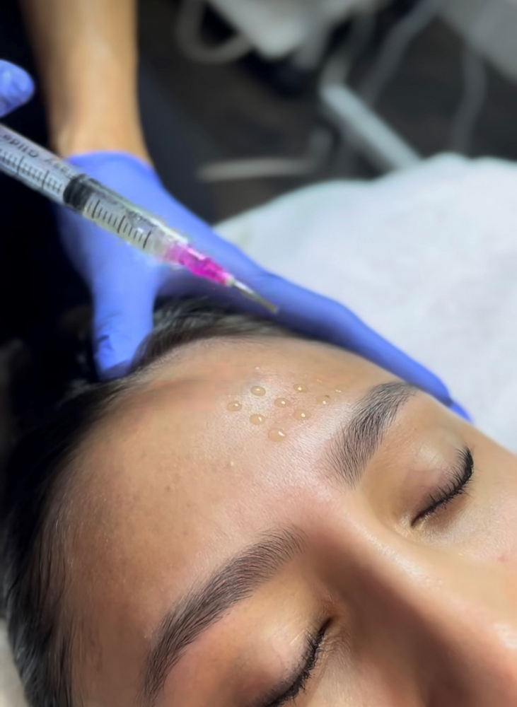 PRX-T33 Treatment at Gravity Med Spa